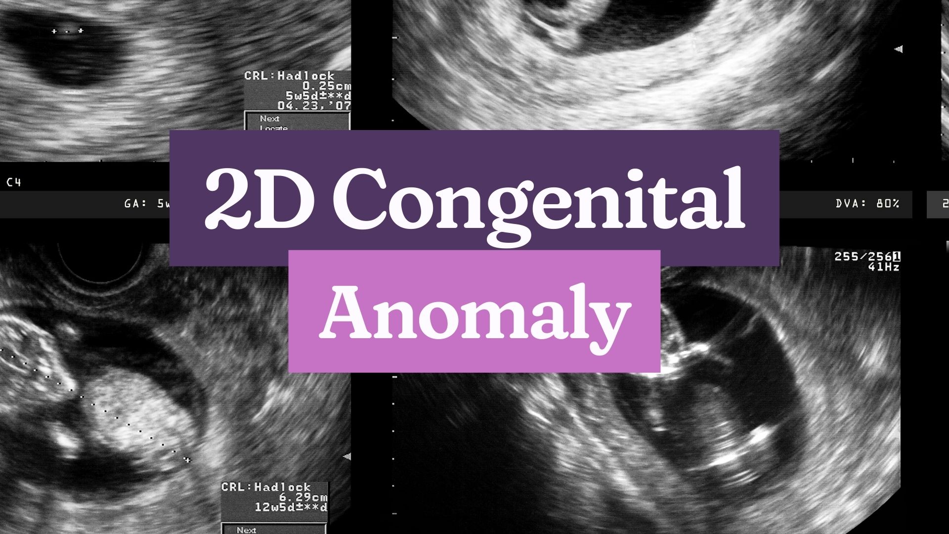2D Congenital Anomaly by Hi-Precision Plus at MOA